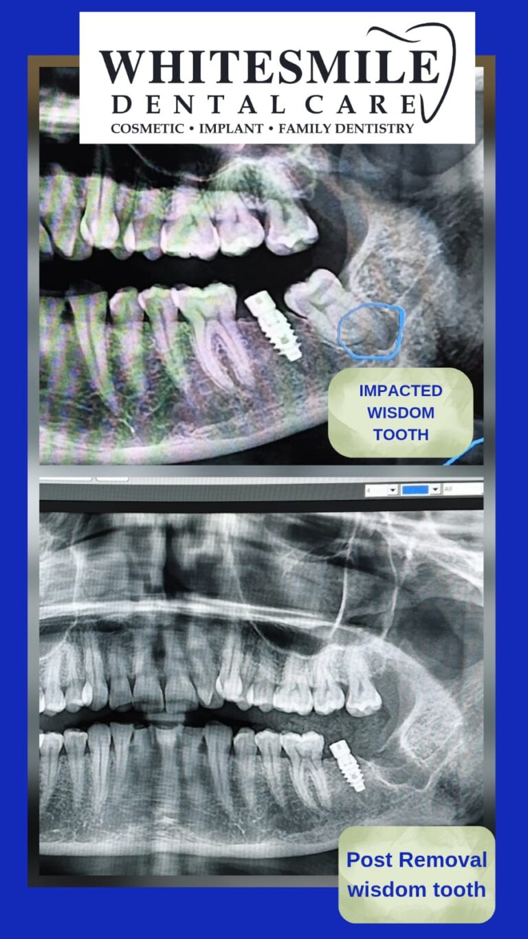 Impacted Wisdom Tooth Removal in Gurgaon | Advanced OPG Scan